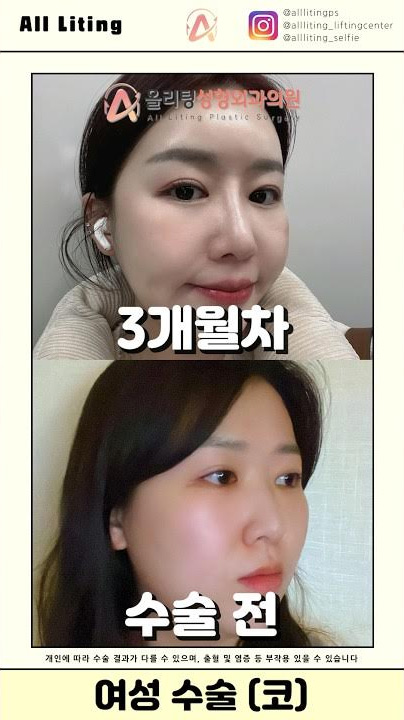 AllLiting Plastic surgery