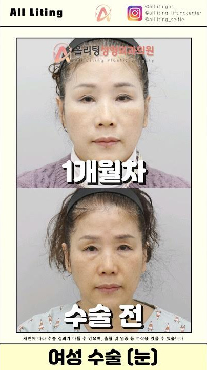 AllLiting Plastic surgery